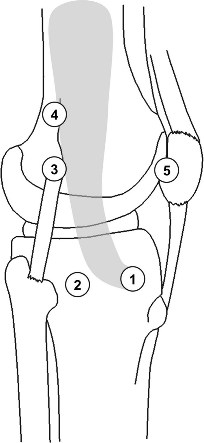Syndrome de la bande ilio-tibiale : causes, symptômes et traitements ...