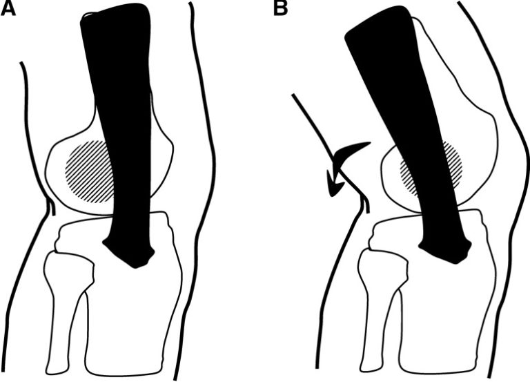 Syndrome de la bande ilio-tibiale : causes, symptômes et traitements ...